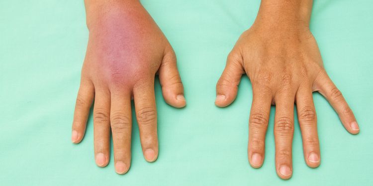 How Inflammation Is Burning Your Health - Healthdish